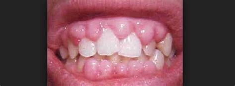 Gamot Sa Pamamaga Ng Gums Ng Bata