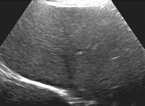 Role Of Us Li Rads In The Li Rads Algorithmradiographics