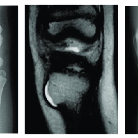 A Radiograph Revealing A Pedunculated Osteochondroma At The Proximal Download Scientific