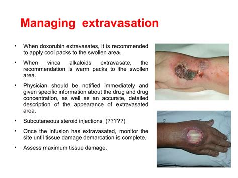 Extravasation Management 1 1 Ppt