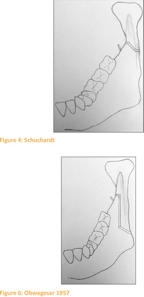 Figure 4 From Bilateral Sagittal Split Osteotomy A Versatile Approach