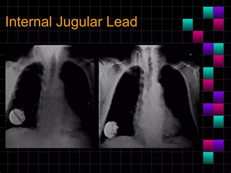 Pacemaker Radiologyanintroduction Ppt