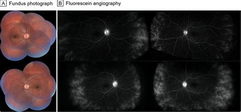 Fundus Photograph And Fa Of Patient 4 A Fundus Photographs Show Mild Download Scientific