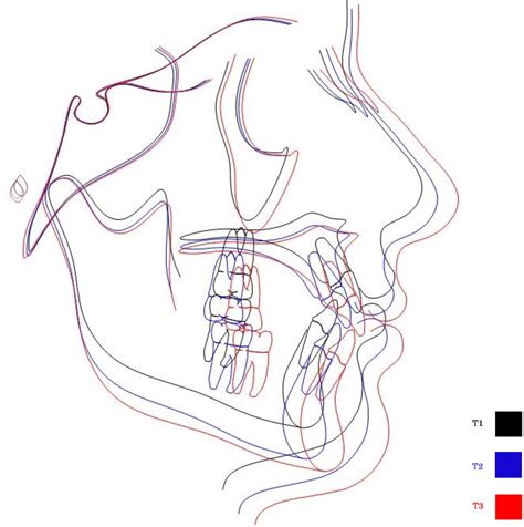 Figure 1 From Long Term Soft Tissue Profile And Incisor Angulation Of