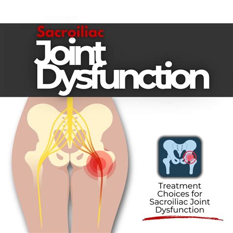 Sacroiliac Dysfunction Sacroiliac Joint Palomar Health San Diego