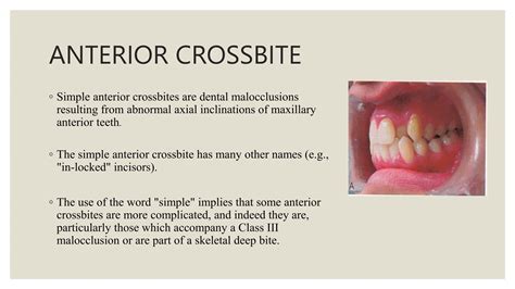 Crossbite Is A Form Of Malocclusion Where A Tooth Or Teeth Has A More