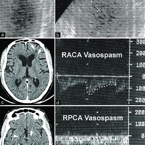 Top Panel Shows Inverted T Waves In The Leads I Ii V3 V4 V5 And V6 Download Scientific