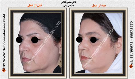 لیفت صورت فوق تخصص جراحی پلاستیک دکتر محسن فدایی