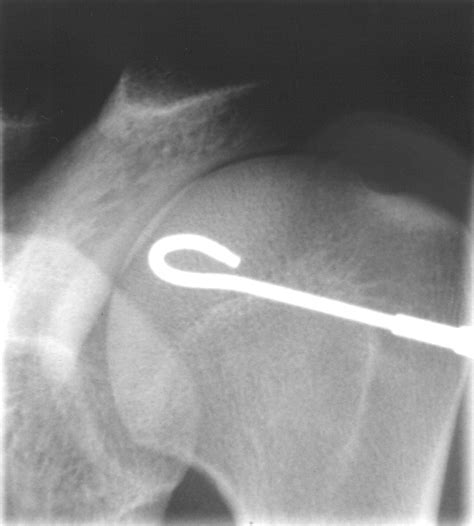 Arthrography Of The Shoulder A Simple Fluoroscopically Guided Approach For Targeting The