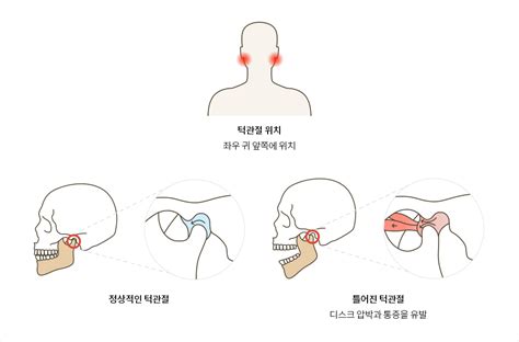 용산역재활필라테스 턱관절통증and턱비대칭 원인과 치료방법 네이버 블로그