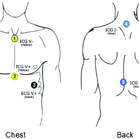 Electrode Placement For Electrocardiography And Impedance Cardiography