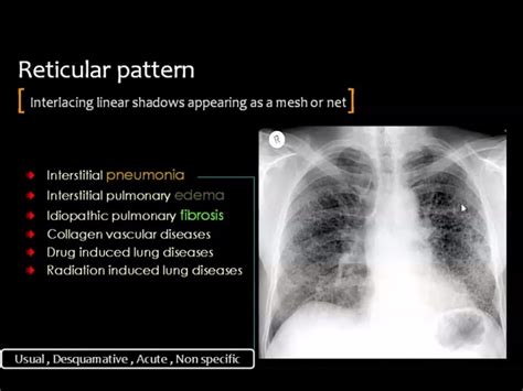 Hrct Reticular Pattern