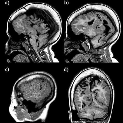 Endoscopic Vision With 0 Optic Showing The Craniopharyngeal Duct And