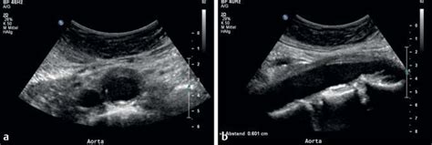 B Mode Ultrasound Imaging At Month Follow Up Using MHz Curved Download Scientific Diagram