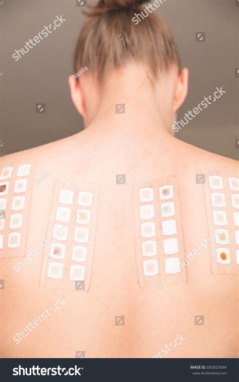 Allergy Patch Test On Back Female 스톡 사진 683925694 Shutterstock