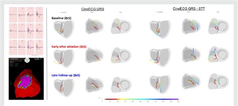 12 Lead Ecg Tracings Cineecgs And Epicardial Potential Duration Map Download Scientific