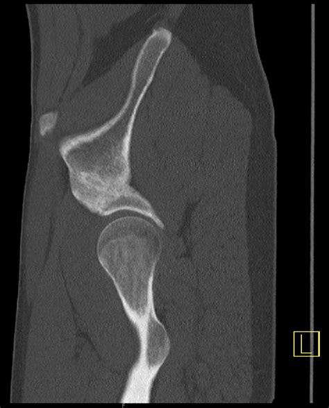 Enteropathic Sacroiliitis Radshare