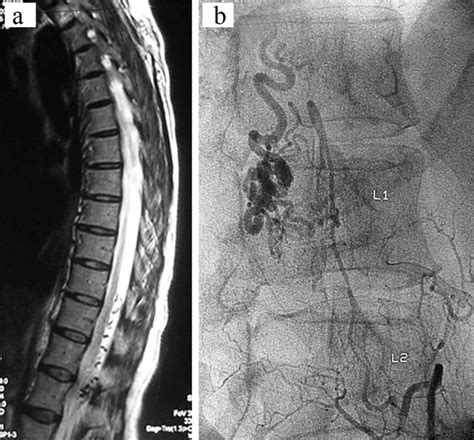 A Thoracic Mri Showed A Vascular Abnormality At The T12 Level B A