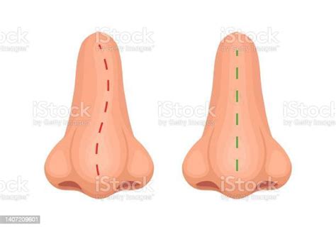 비뚤어지고 올바른 코 치료 전후의 코 벡터 일러스트 레이 션 코에 대한 스톡 벡터 아트 및 기타 이미지 코 벡터 깨짐 Istock