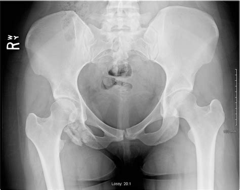 Treating A Pelvic Ischial Tuberosity Fracture Ygdyqy