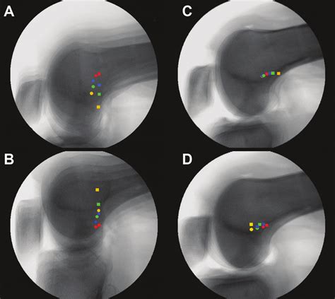 True Lateral Right Knee Fluoroscopic Radiographs With Digitally