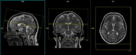 Mri Brain Protocols Planning Positioning And Indications