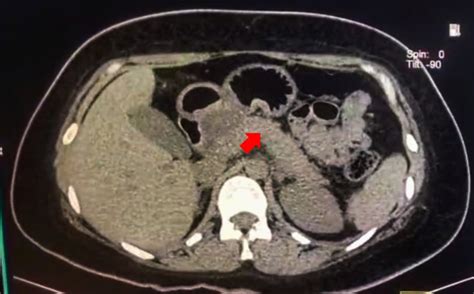 Severe Pancreatic Involvement In Severe Dengue Simultaneous Presentation Of Acute Pancreatitis
