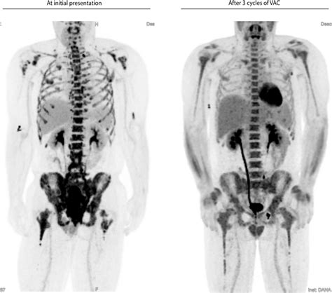 Hyperfibrinolysis During The Treatment Of Rhabdomyosarcoma Pmc