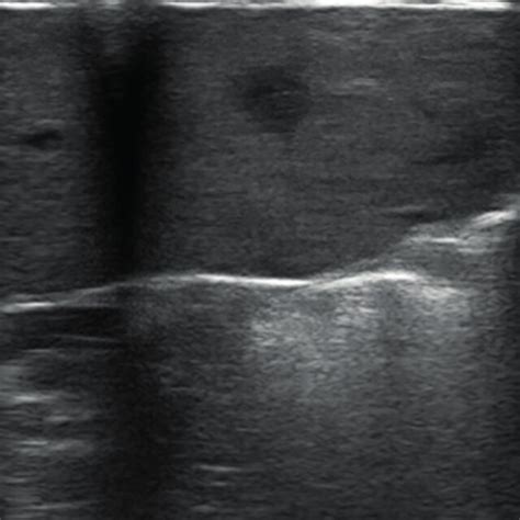 First Us Exam High Frequency Probe Irregular Echostructure And