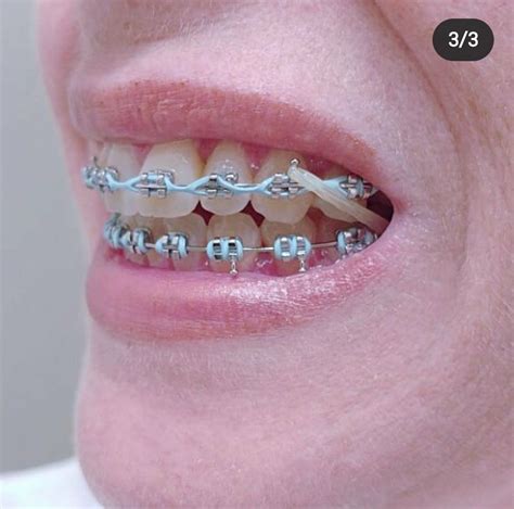 Pin On Braces