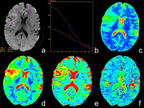 A Case Of Low Grade Glioma A Axial Diffusion Weighted Trace Image