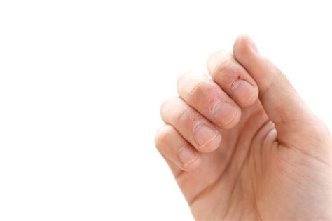 Qu Son Los Padrastros Y Por Qu Nunca Debes Arranc Rtelos Onda Vasca