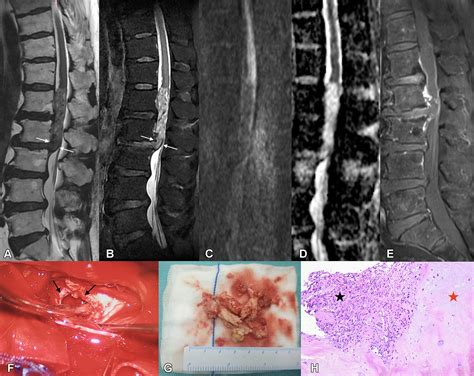 Intradural Disk Herniation Radiology
