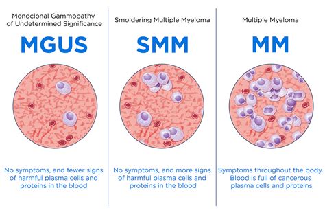 Multiple Myeloma Memorial Sloan Kettering Cancer Center