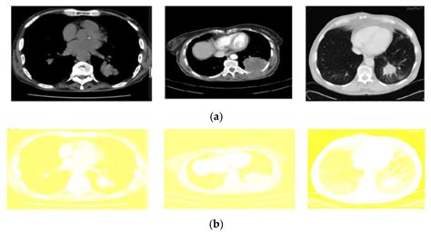Deep Learning Based Bovw Crnn Model For Lung Tumor Detection In Nano Segmented Ct Images