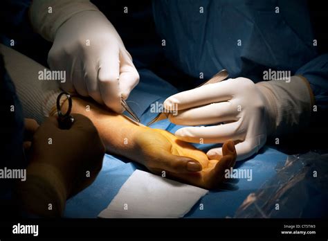Carpal Tunnel Surgery Hi Res Stock Photography And Images Alamy