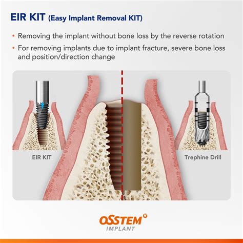 Esr Kit And Eir Kit Are Used For Osstem Hong Kong