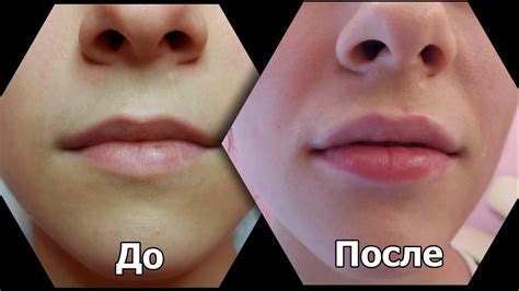 До и после. Увеличение губ препаратом Perfectha Derm (1мл) - YouTube