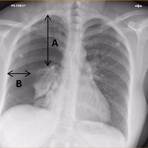 British Thoracic Society Guidelines On Spontaneous Pneumothorax Credit Download Scientific