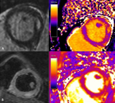 Mri Diagnosis Of An Acute Myocarditis Mri Findings Of The Patient Who
