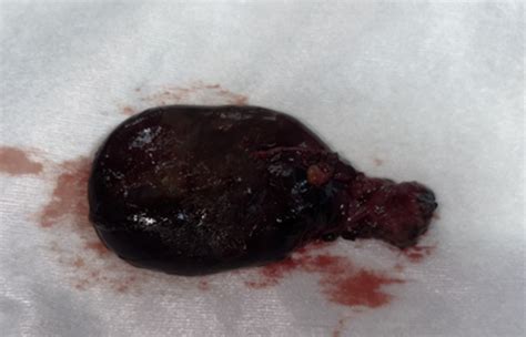 The Diagnostic Challenge Of Gallbladder Volvulus A Case Report Auctores