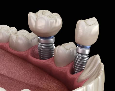 Premolar Molar Tooth Crown Installation Implant Abutments Medically