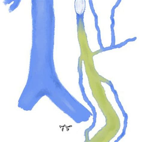 Drawing Shows Spermatic Vein Embolization With Glue Glue Is