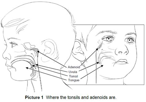 Before And After Tonsillectomy