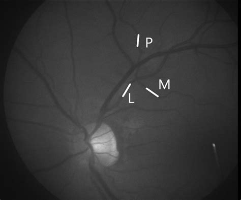 An Image From A Dynamic Vessel Analyzer Examination The Selected