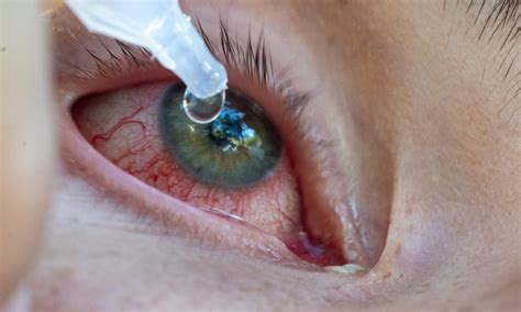 Topical Antibiotics Effective In Conjunctivitis