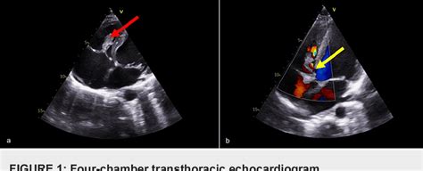[pdf] A Case Report Of Acute Infective Endocarditis Caused By