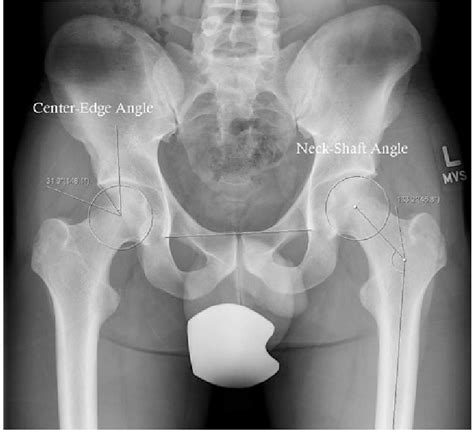 An Ap Pelvis Radiograph Demonstrates Measurement Of Lateral Cea On The Download Scientific