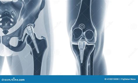 Implants Knee Of Metal And Plasticthe Knee Prosthesis Replaces The
