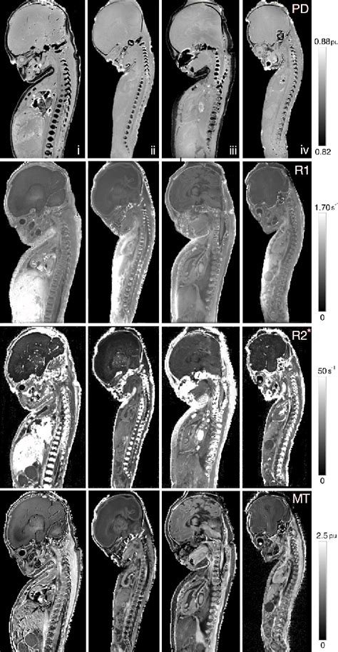 sagittal mpm maps of all four cases at 3 t pd r 1 r 2 and mt